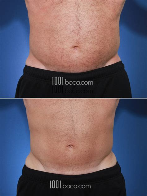 Coolsculpting Before And After Photos