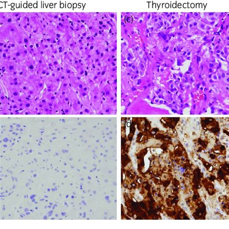 Pathology Of The Present Case Ab A Pathological Specimen Of