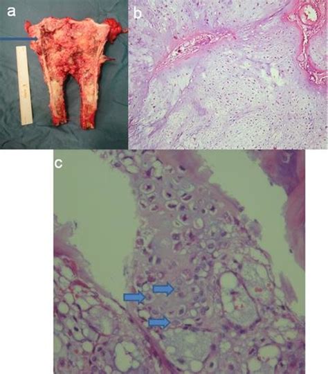 A Sagittally Bisected Resection Specimen Of The Proximal Tibia Download Scientific Diagram