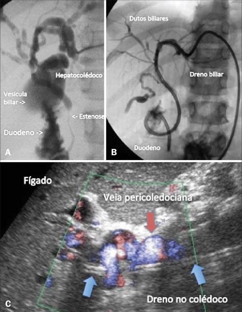 A Percutaneous Cholangiography Demonstrating Dilatation Of The Biliary Download Scientific