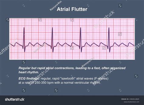 Ecg Atrial Flutter Abnormal Heart Rhythm Stock Illustration 2393512825