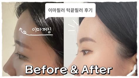이마필러3cc And 턱끝필러 1cc 후기 시술과정 통증 전후 비교 결혼 전 예비신부 관리 Youtube
