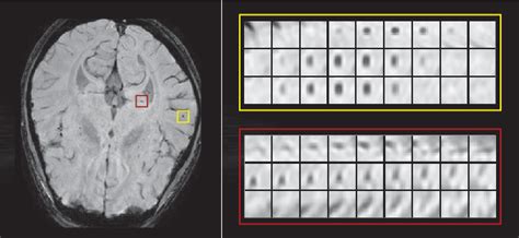 Figure 1 From Automatic Detection Of Cerebral Microbleeds From Mr Images Via 3d Convolutional
