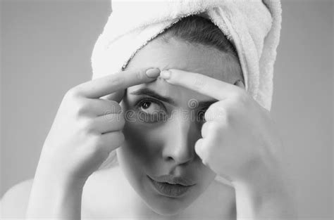 Young Woman Squeeze Pimples Girl With Acne And Pimple On Skin