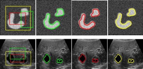 Segmentasi Citra Kepala Mri Menggunakan Metode Active Contour Pemrograman Matlab