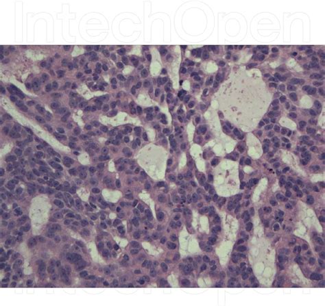Figure 3 From Basaloid Squamous Cell Carcinoma Semantic Scholar
