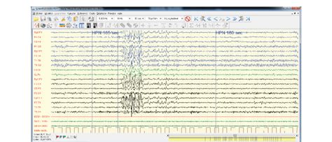 Critical Eeg With Pseudo Rhythmic Puffs Of Bilateral Frontal