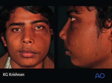 Partial Ostectomy And Contouring For Extensive Fibrous Dysplasia Partial Ostectomy And Contouring For Extensive Fibrous Dysplasia