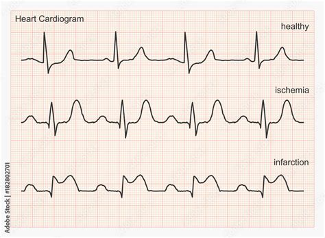 Heart Rhythm Chart
