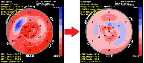Subclinical Systolic Dysfunction During Chemotherapy For Breast Cancer International Journal