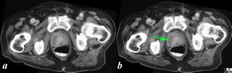 Abscess The Common Vein