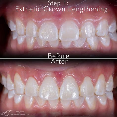 Veneers And Esthetic Crown Lengthening Fantaskismiles