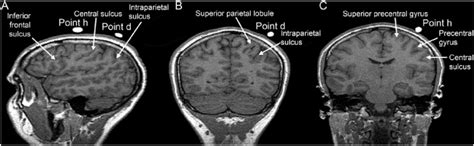 Intraparietal Sulcus Mri