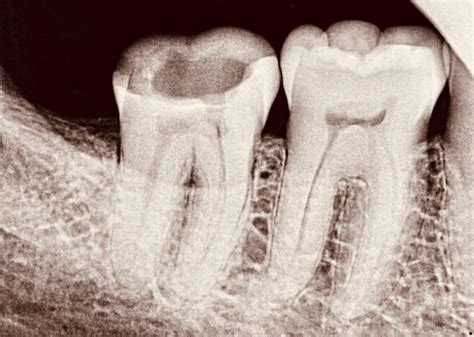 A Plain Radiograph Of The Trabecular Bone Of The Mandible Download Scientific Diagram