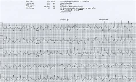 Ecg Basics And Fundamentals Right Axis Deviation Differential And St Segment Elevation In