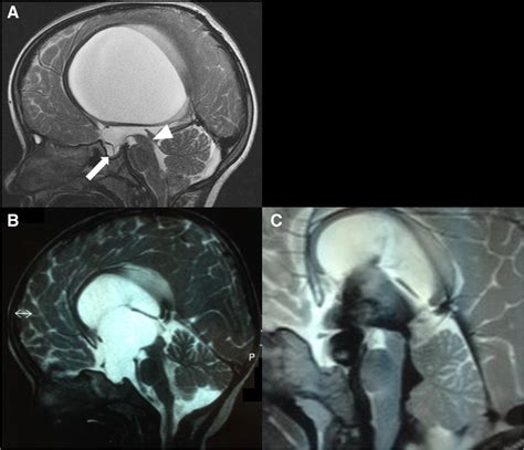 Hydrocephalus Due To Aqueductal Stenosis A Sagittal T2 Weighted Image