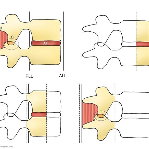 Neurosurgery Blog — Denis Classification Divided The Vertebral Spine