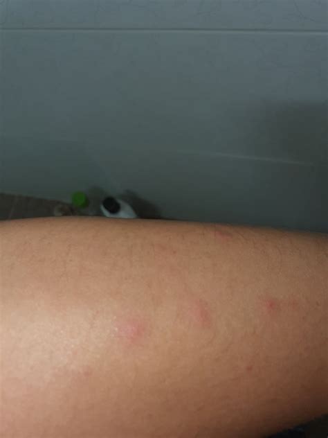 피부에 붉은 반점이 생겼는데요 지식in