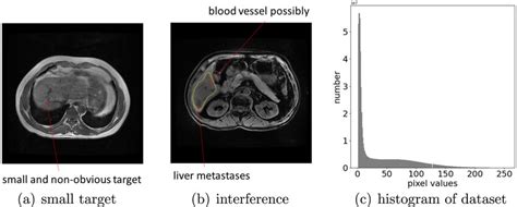 Illustration Of Challenges In The Segmentation Of Liver Metastases In Download Scientific