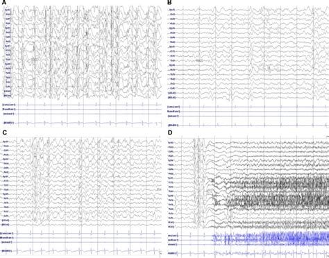 Preoperative Eeg Features Generalized Slow Sharp And Wave Discharges Download Scientific