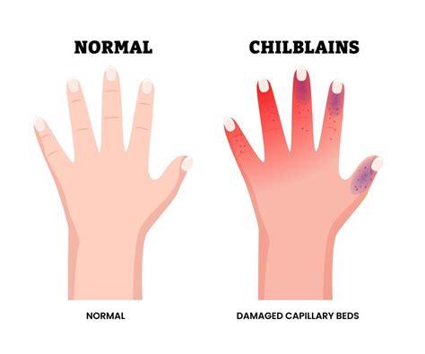 Normal And Chilblains Hand Condition Symptoms Medical Illustration