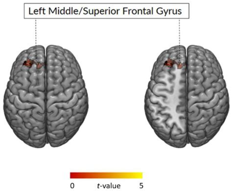 Neuroanatomical Correlates Of Binge Eating Behavior At The Roots Of Unstoppable Eating
