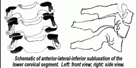 Anterior Lower Cervical Syndrome The Subluxation Dynamic Chiropractic