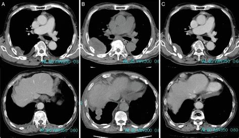 A Primary Tumour On Chest Computed Tomography Ct B Chest Ct