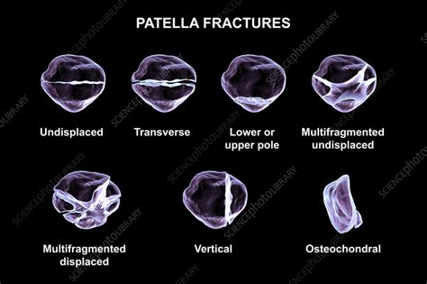 Classification Of Patella Fractures Illustration Stock Image F044