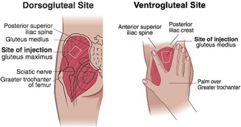 Intramuscular Injection Sites Collage Template
