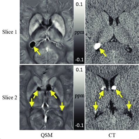 Quantitative Susceptibility Mapping And Computed Tomography Showing