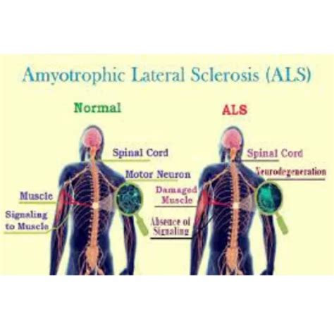 Amyotrophic Lateral Sclerosis Treatment At ₹ 2500pack In Noida Id