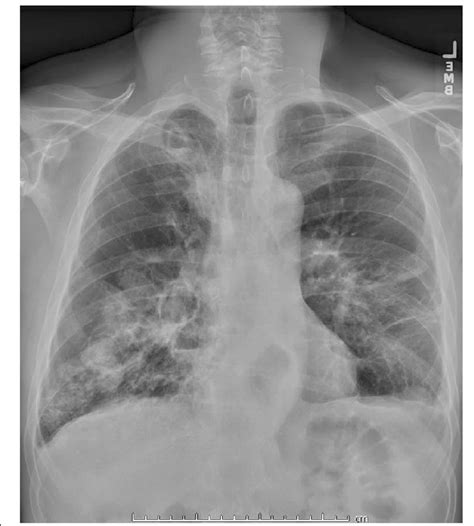 Bronchiectasis X Ray
