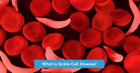 What Is Sickle Cell Disease Prepladde