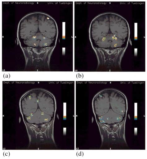 114 11 Individual Activation Maps Superimposed On Conventional