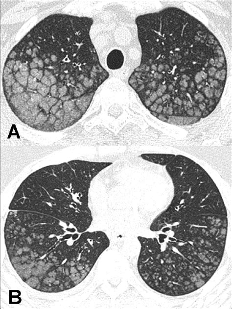 37 Year Old Woman With Biopsy Proven Metastatic Pulmonary Calcification Download Scientific