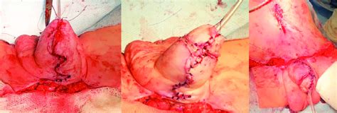 Phalloplasty Surgical Technique Continued A A Skin Flap Is Folded