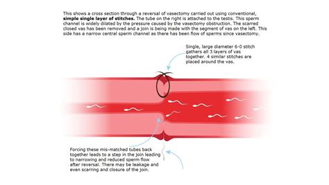 Seven Must Know Facts About Vasectomy Reversals Best Life Microsurgery