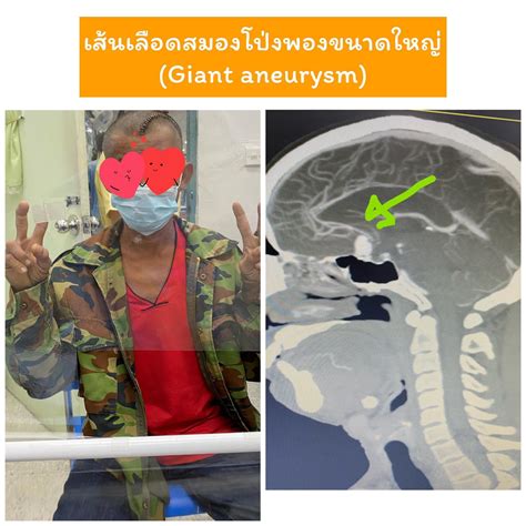 เส้นเลือดสมองโป่งพองขนาดใหญ่ Giant Intracranial Aneurysm โรคหลอดเลือดสมองโป่งพองแตก Aneurysm