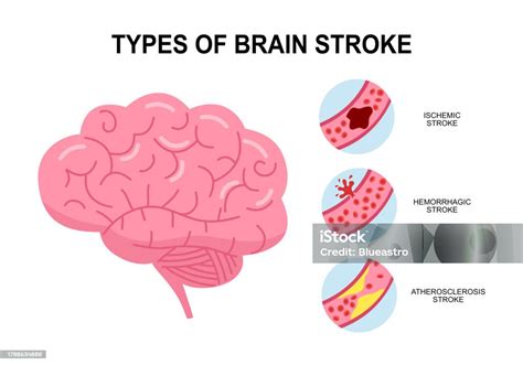 Stroke Disease Ischemic Atherosclerosis And Hemorrhagic Scientific