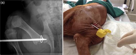 Intraosseous Injection Of The Femoral Head A Under Radiographic Download Scientific Diagram