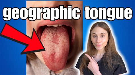 Migratory Tongue Why Are There Patches On My Tongue