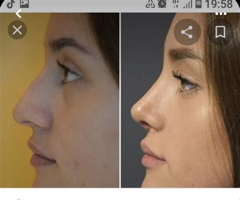 Long Nose Job Natural Nose Jobs Pixie Nose Rhinoplasty Nose Plastic