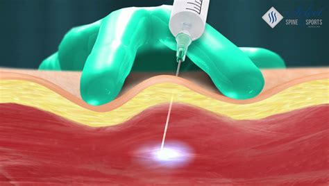 Trigger Point Injections Friendswood Tx