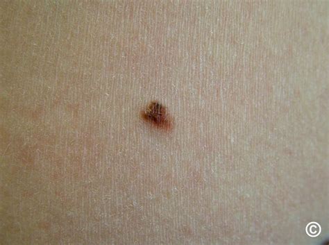 Early Malignant Melanoma In Situ