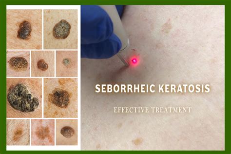Laser Ablation For Seborrheic Keratosis At Ruth Tolbert Blog