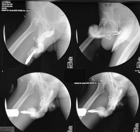 Urethrography With Retrograde Urethrogram Fluoroscopy Contrast