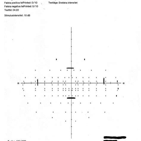 An Hvf Test From One Of The Subjects Included Missed Test Points Can Download Scientific