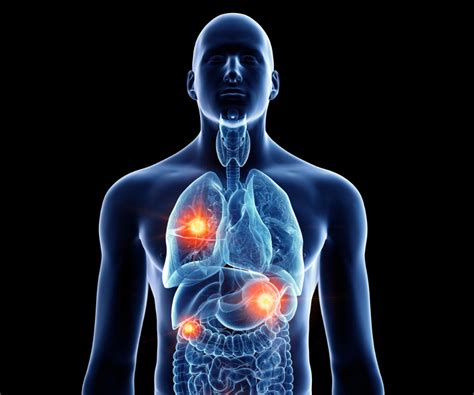 Can X Rays Detect Cancer Myths Vs Facts Sk Radiology