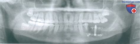 Пример дистракционного остеогенеза послеоперационного дефекта бокового отдела альвеолярной части